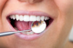 Lingual Braces vs. Invisalign: Which is Best for You?